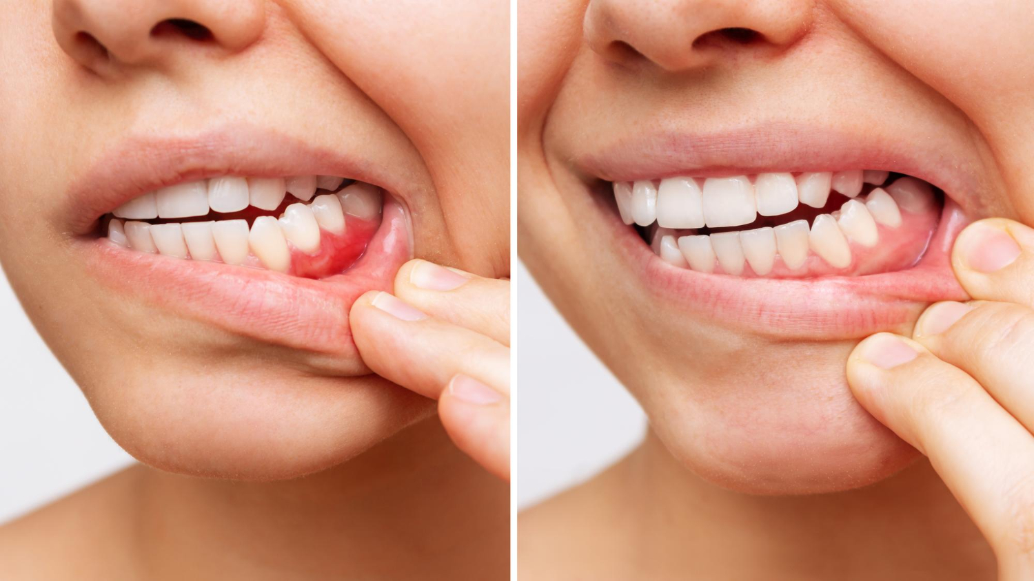 Treatment For Gums - Divine Smiles Plus Dental Clinic