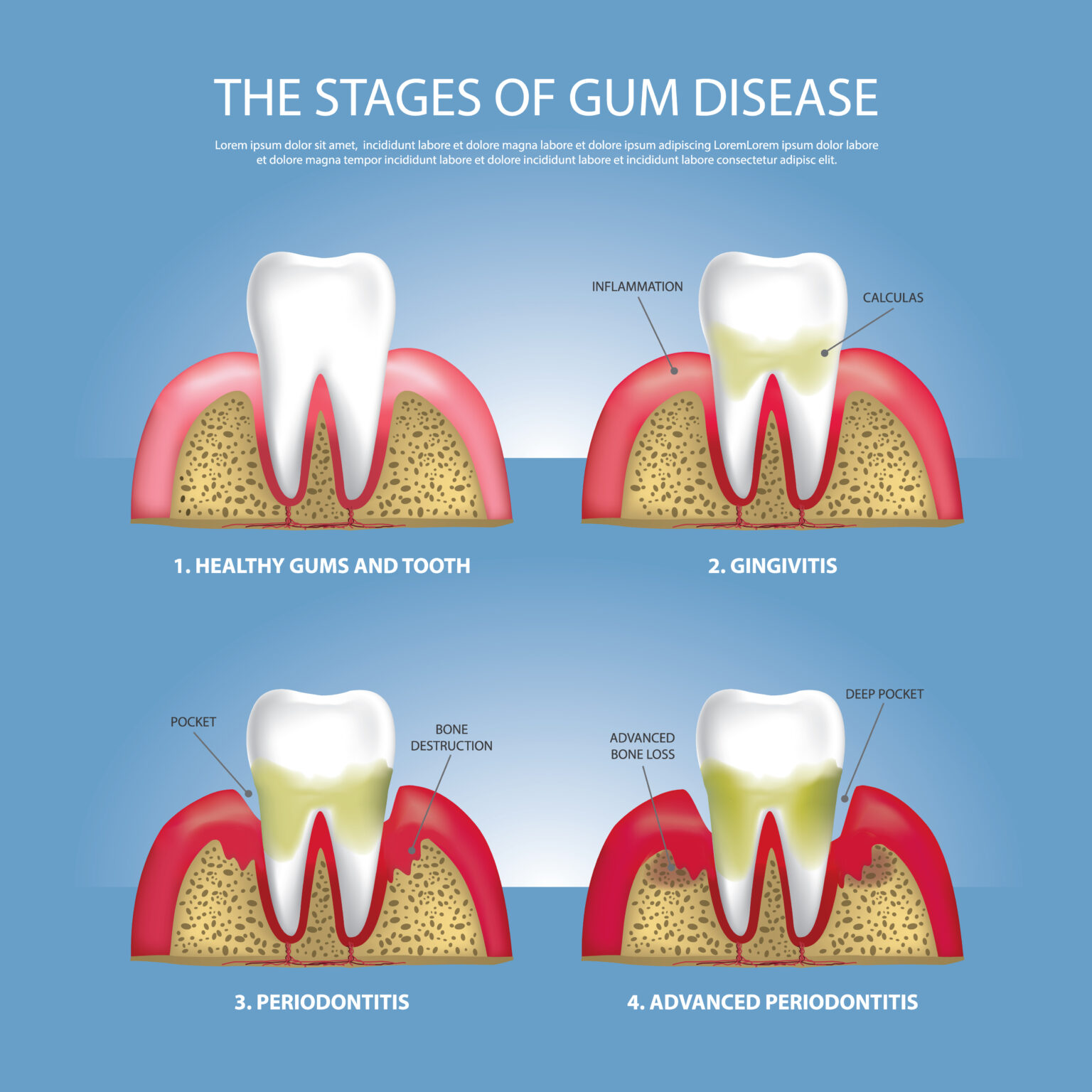 Treatment For Gums - Divine Smiles Plus Dental Clinic